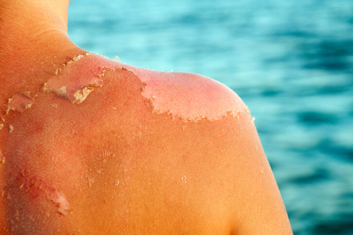 Hot Spot Healing: How to Treat Minor Burns - American Outdoor Guide